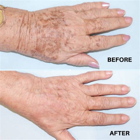 Hyperpigmentation Arms