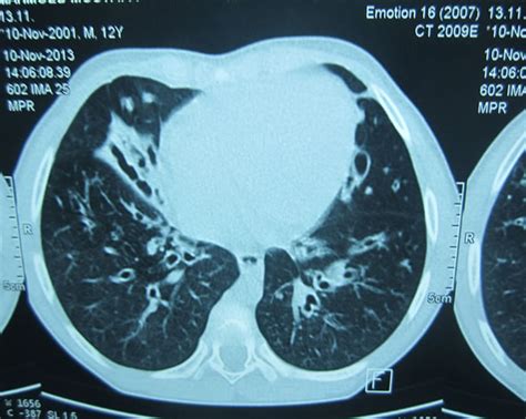 Impact Of Cystic Versus Cylindrical Types Of Bronchiectasis On