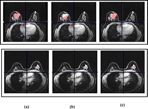 Image Augmentation Based On Variational Autoencoder For Breast Tumor Segmentation Academic