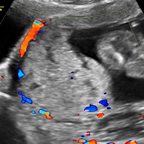 Interstitial Line Sign Visualization Of Echogenic Line Runs From