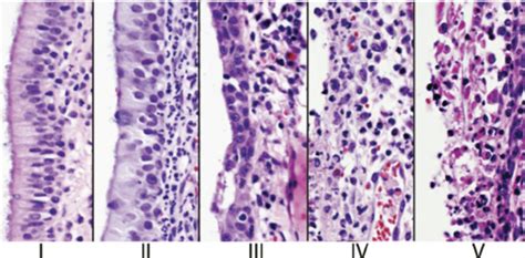 Nasal Cavity Maxillary Turbinates The Histologic Grading Scheme For
