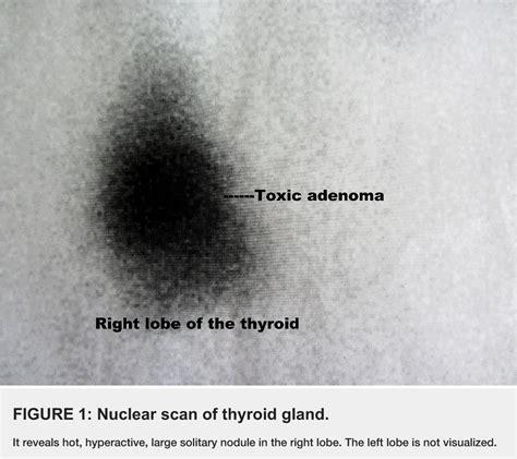 Figure 1 From Toxic Adenoma In A Patient With Thyroid Hemiagenesis Semantic Scholar