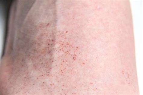 배경에 대한 남성의 발에 붉은 발진 빨간 알레르기 성 발진이있는 다리의 일부를 클로즈업하십시오 알레르기가있는 피부 피부에 대한 스톡 사진 및 기타 이미지 Istock