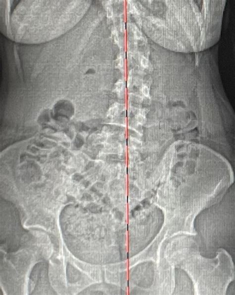 Ummmmm Is My Colon Redundant Rconstipation