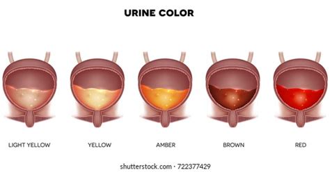 Tea Colored Urine Hematuria