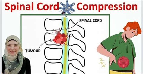 Dr Nora Abdelhafiz On Linkedin Malignant Spinal Cord Compression