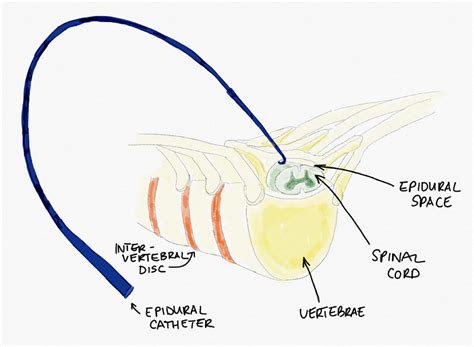 Epidural Catheter Insertion After Surgical Correction The Spinal Download Scientific Diagram