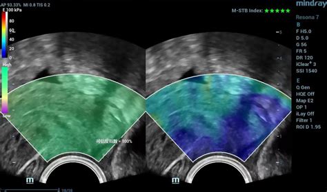 Two Dimensional Shear Wave Elastography Image Under Strict Quality Download Scientific Diagram
