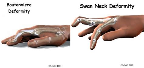 The Hand Examination Stanford Medicine 25 Stanford Medicine