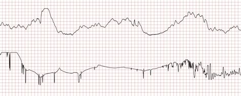 Ventricular Tachycardia Fibrillation Flutter Monomorphic Polymorphic 1 The Cardiovascular