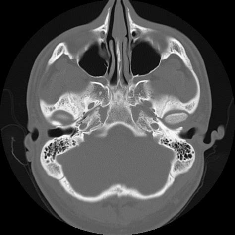 Normal Temporal Bone Ct With Annotated Images Radiopaedia 84293 99584