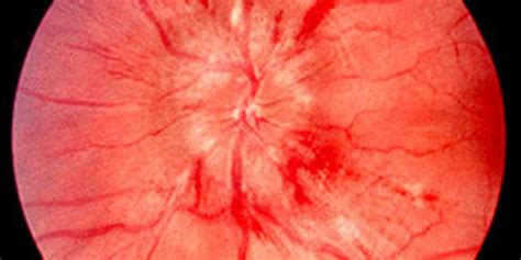 Artificial Intelligence Deep Learning Algorithm Identifies Papilledema From Fundus Photographs
