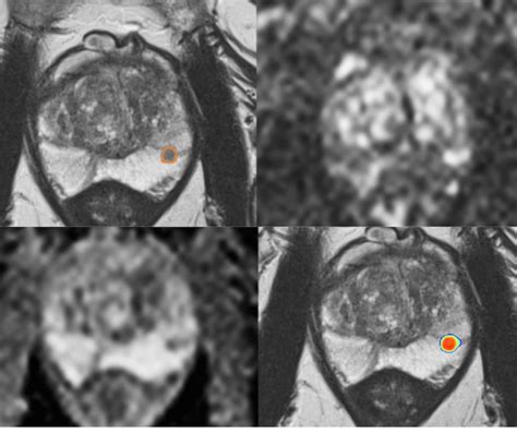 Could Mri Based Ai Offer Better Risk Stratification For Prostate Cancer