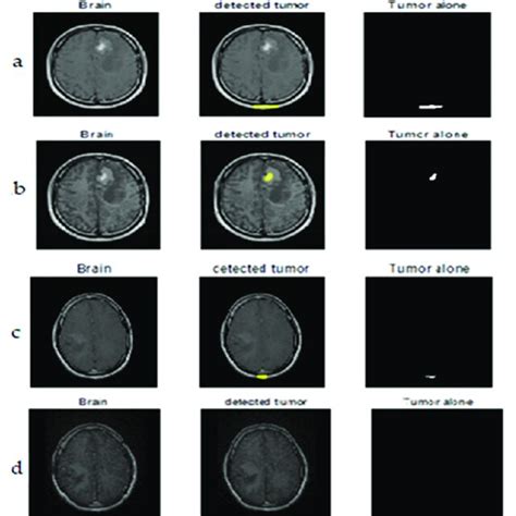 Tumor Detection From Original Mri Brain Images A The First Image In Download Scientific