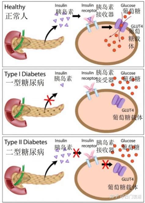 胰岛素抵抗与二型糖尿病 知乎