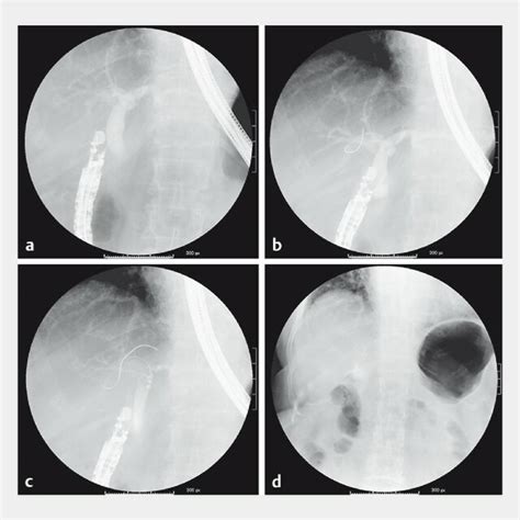 This Figure Shows The Number Of ERCP Cases During The Study Period And Download Scientific