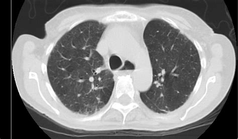 Scleroderma A Focus On Pulmonary Findings Eurorad