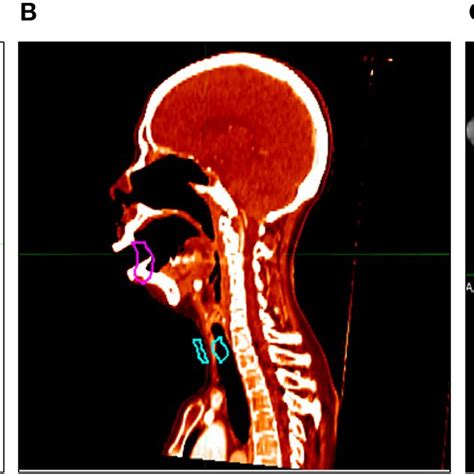 Auto Segmented Contour Results With Open Mouth Target Patient A Download Scientific Diagram