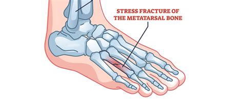 Stress Fractures Advanced Foot Care