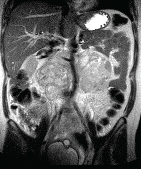 Radiology Of Synovial Sarcoma Case Magnetic Resonance Imaging Prior To
