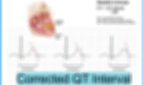 Qt Corrected Interval Calculator Accurate Qtc Calculation