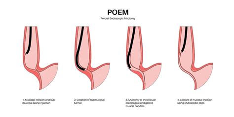 Miotomía Endoscópica Peroral Poem Procedimiento Mínimamente Invasivo