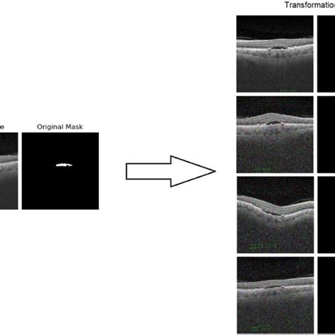 Oct Image Showing Subretinal Fluid Associated With Amd Surrounded By A Download Scientific