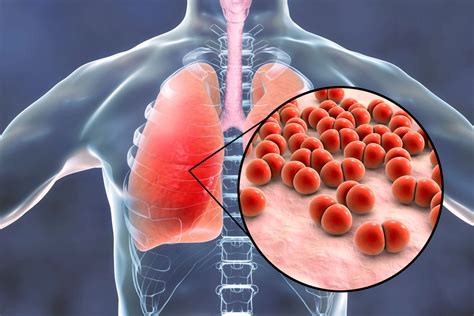 Mengenal Pneumonia Bilateral Yang Dialami Paus Fransiskus Penyebab
