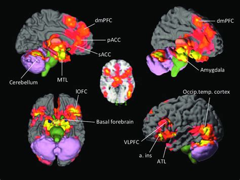 Meta Analytic Findings Of Emotion Brain Areas With A Consistent