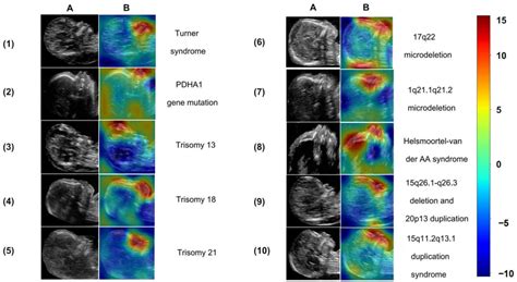 The Heatmap By Grad Cam Algorithm Overlaid On Original Images With Red