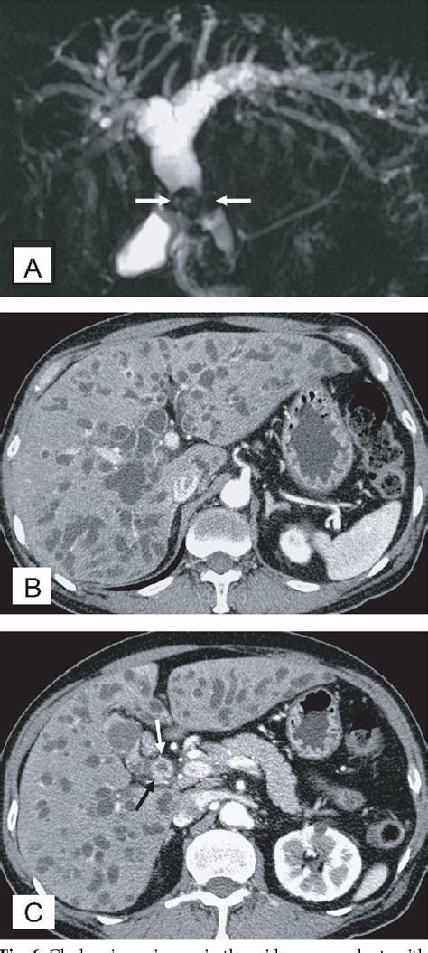 Figure 1 From Imaging Diagnosis Of Clonorchiasis Semantic Scholar