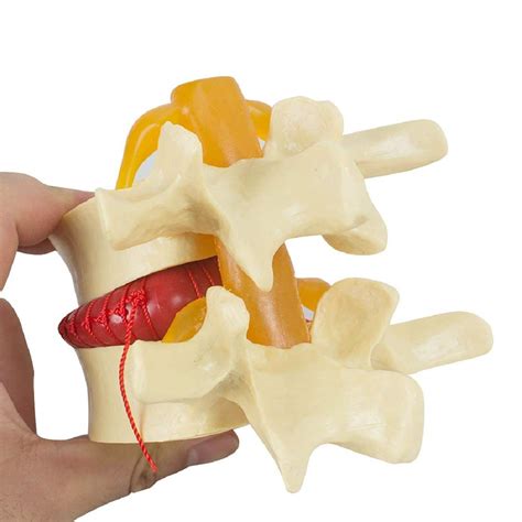 Buy Human Model 11 Lumbar Disc Herniation Demonstration Model Human
