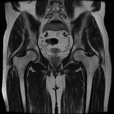 Piriformis Muscle Mri
