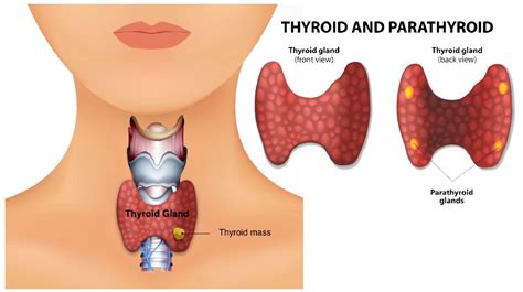 Thyroid Enlargement And Difficulty Swallowing Dysphagia Artofit