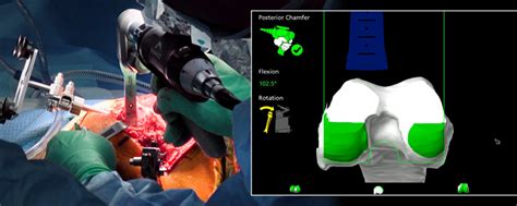 Video Mako Robotic Arm Assisted Total Knee Arthroplasty Journal Of