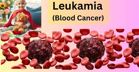 Leukemia Symptoms Types And Treatment Options 2025