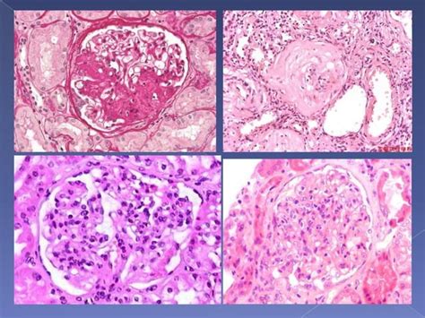 Interpretation Of Renal Biopsy Pptx