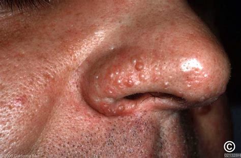 Tuberous Sclerosis