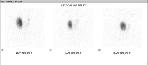Hot Nodule Titan Radiology