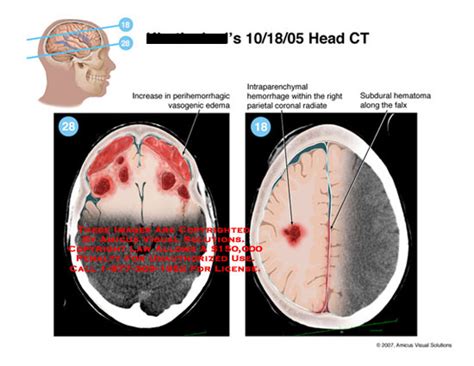 Amicus Illustration Of Amicus Radiology Brain Axial Ct Perihemorrhagic