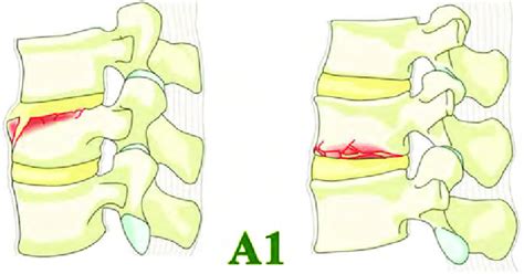 Subtype A1 Wedge Compression Fracture Of A Single Endplate Without Download Scientific