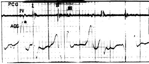 Figure 1 From Massive Calcification Of The Myocardium Semantic Scholar