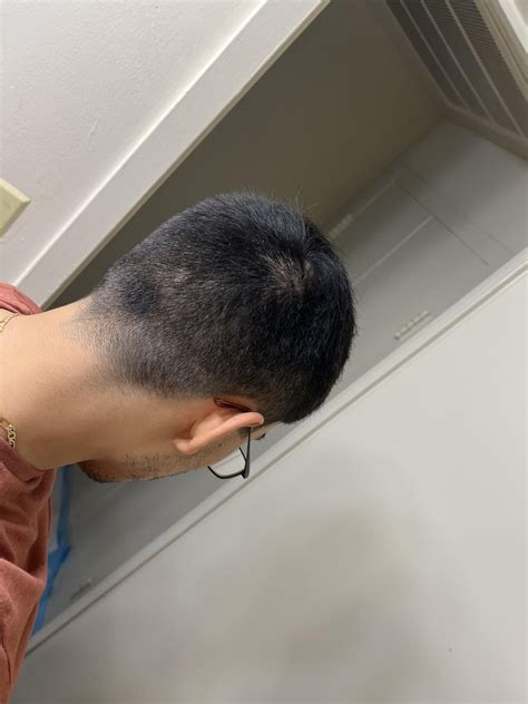 Could This Be Diffuse Alopecia Areata Mixed With Aga Ralopeciaareata