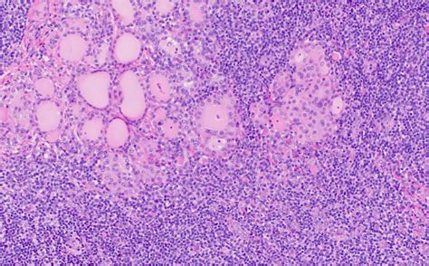 Thyroiditis My Endo Consult