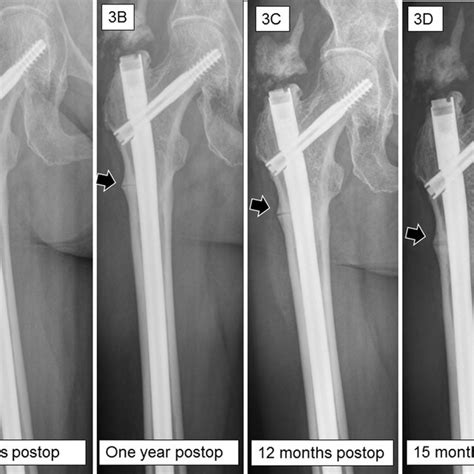 Pdf Progression Of Bisphosphonate Associated Impending Atypical Femoral Fracture Despite
