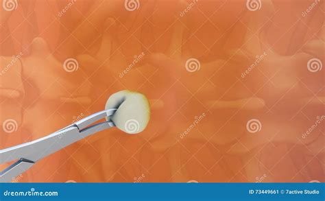 Spinal Anaesthesia Stock Illustration Illustration Of Equipment 73449661