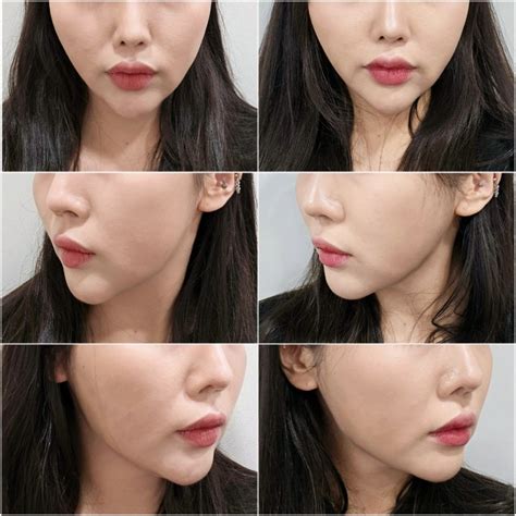 압구정피부과 울쎄라 부작용 통증 없는 온다리프팅 자세한 후기 효과 주기 가격 네이버 블로그