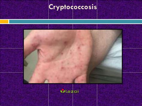 Ppt Cryptococcosis Powerpoint Presentation Free Download Id7936121