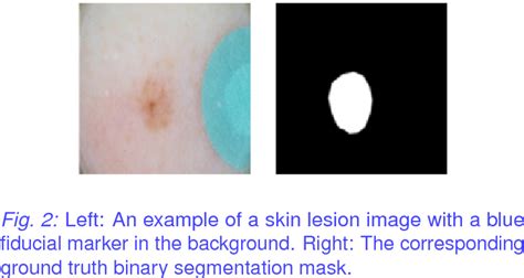 Figure 2 From Skin Lesion Segmentation Using Deep Hypercolumn Descriptors Semantic Scholar