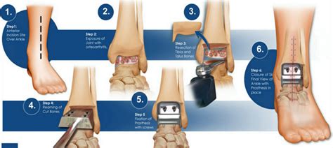 Facts About Ankle Replacement Surgery